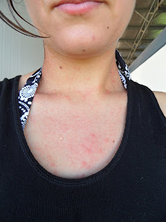 poluxvoyage: Mango rash