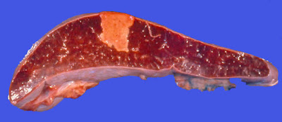 Seguindo a Patologia: NECROSE DE COAGULAÇÃO