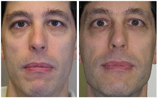 Facial Development Newsletter: Treat your Sleep Apnea Patients with the ...