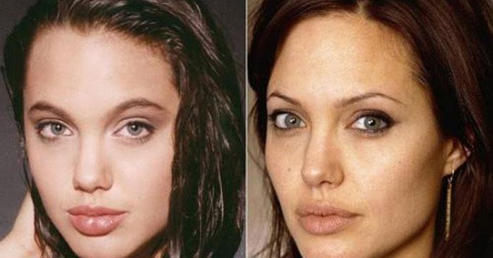 Rinoplastias de lujo o famosas con la nariz operada