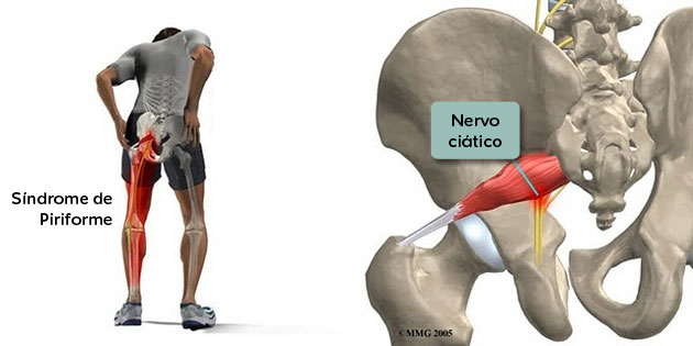 PILATES RAQUEL OLIVEIRA: Síndrome do Piriforme