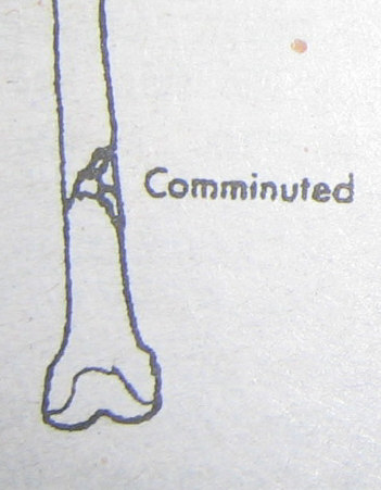 anatomy and physiology: Types of Fractures