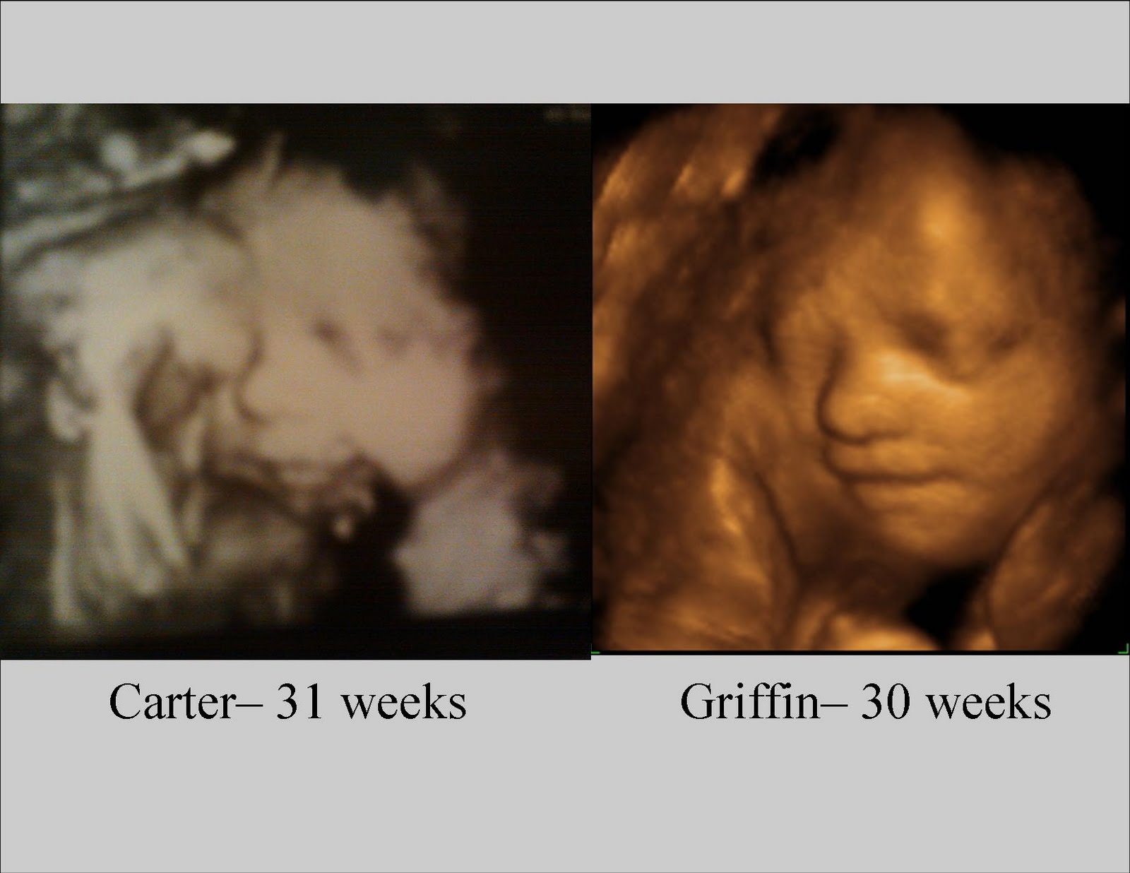The Isham's: Carter's 31 week ultrasound