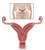 konsultasi dokter: Penyebab Gatal pada Organ Intim Wanita (Vagina)