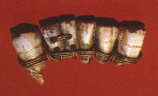 PRÓTESE ODONTOLÓGICA: PRÓTESES NA ANTIGUIDADE