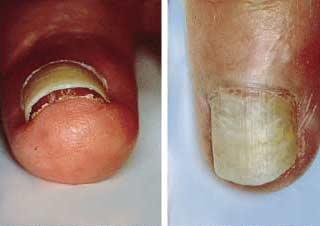 KLAUDYA NAILS: UNGHII BOLNAVE