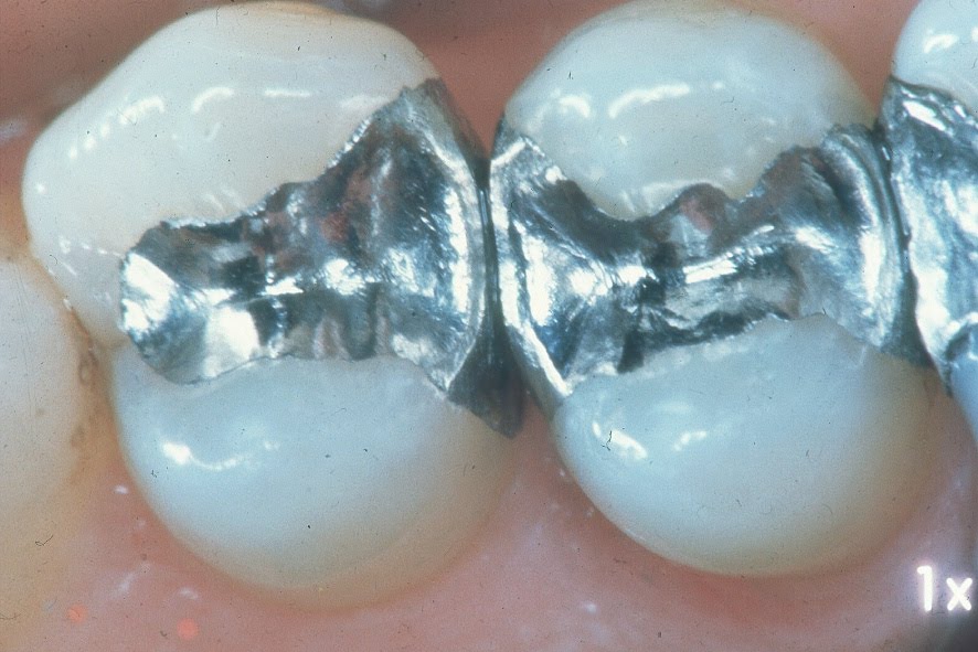 Biomateriales Dentales: Amalgamas Dentales