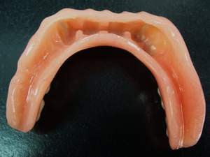 Prótesis Total 2 nivel AALD: Prótesis Total