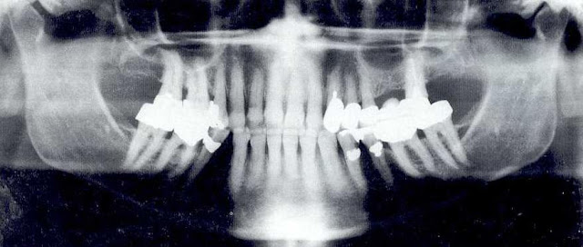 Arthrites et dysfonctionnements de l'ATM