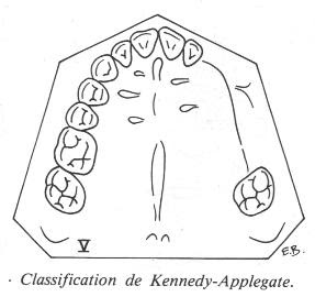 Classification des édentements