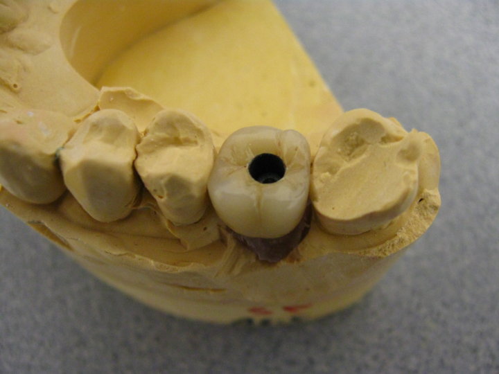 My ♥ Dentistry ☆: Screw-Retained Implant Crowns