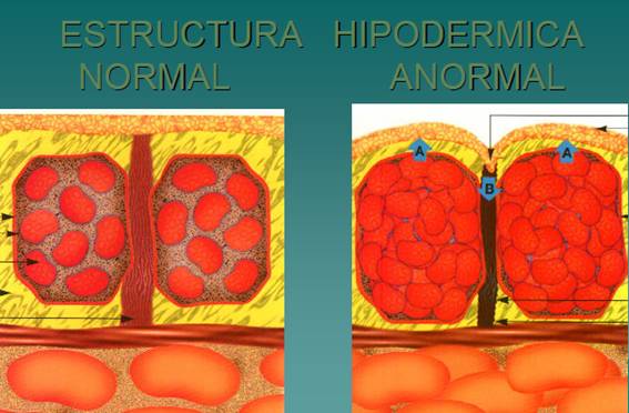 Estetica Medica: CELULITIS O PEFE (paniculopatía edemato fibro esclerótica)