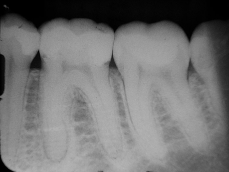EQUIPE DE ENDODONTIA DE CAMPINAS: caso dente 36