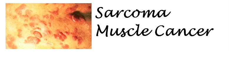 sarcoma muscle cancer