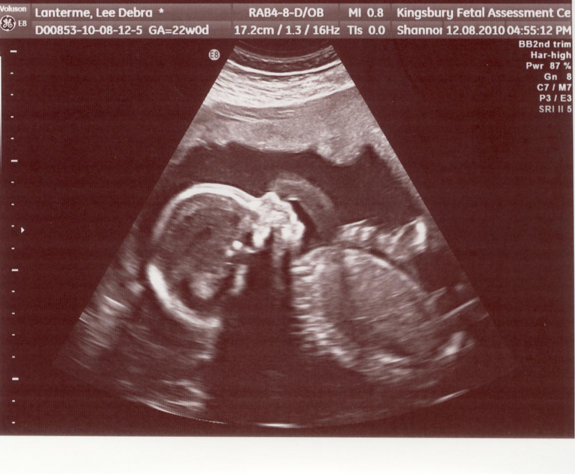 Baby Lanterme: 22 week scan