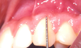 Orthodontic Corner: Post Orthodontic Recession Defects, Modified Approach