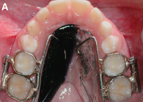 Orthodontic Corner: Non compliance first molar distalization, AmJO May 2010