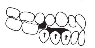 Orthodontic Corner: Design and Management of Twin Blocks