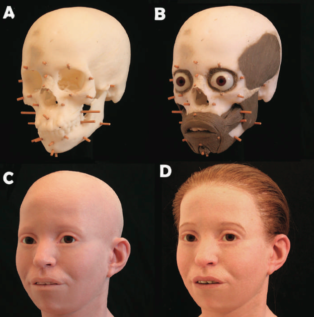 Orthodontic Corner: Facial Reconstruction of an 11 year old female ...