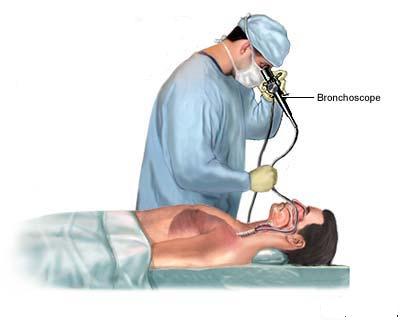 Broncofibroscopia