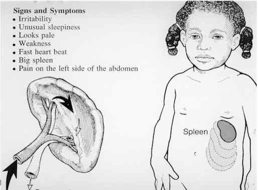 Easy Pediatrics: Acute Splenic Sequestration Crises In Sickle Cell Anemia