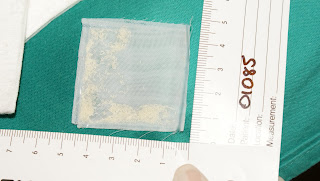 The Wound Healer: Elective use of maggots in septic diabetic foot