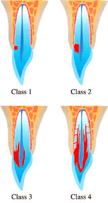 Innovative Endodontics in Ellicott City Maryland: Invasive Cervical ...