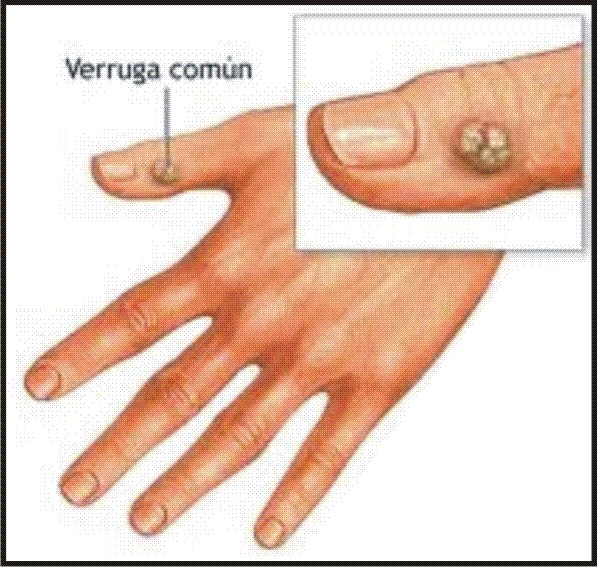 Revista Saludablemente: VERRUGAS... INOFENSIVAS PERO CONTAGIOSAS
