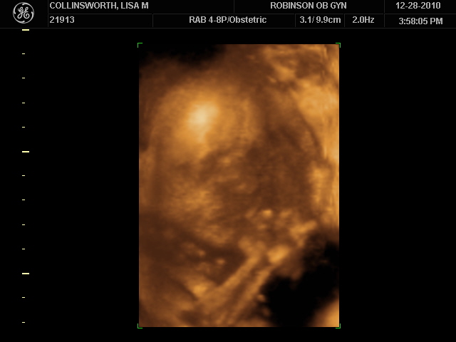 mercurux: 3d ultrasound pictures at 26 weeks