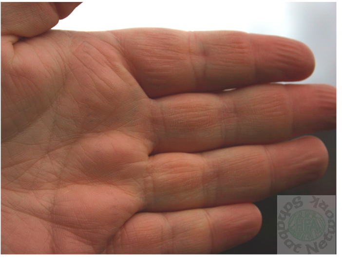 Isu-isu berkaitan HPA: Diagnosis tapak tangan