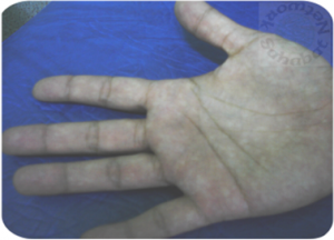 Isu-isu berkaitan HPA: Diagnosis tapak tangan