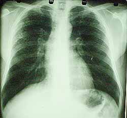 Vida Melhor por Kessler Quinderé: Pneumoconioses