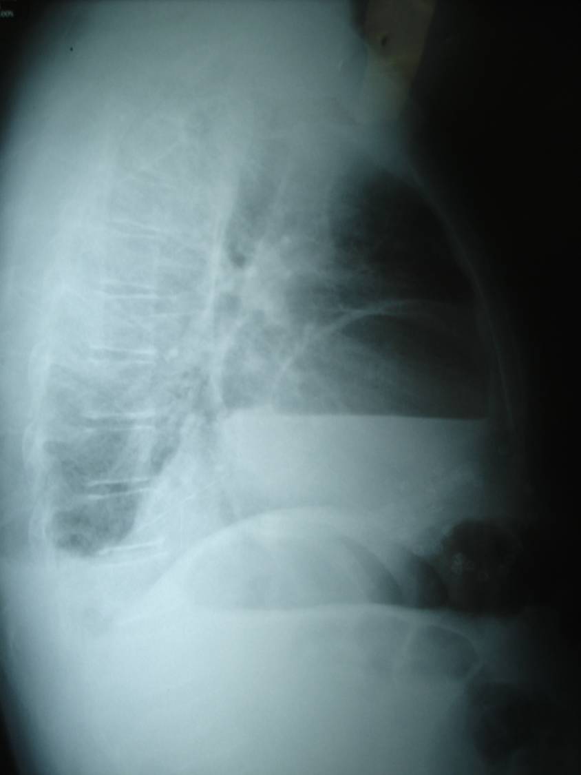 ALFREDO JIMÉNEZ BERNADÓ: HERNIA DE LARREY MORGAGNI: TRATAMIENTO POR ...