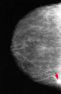 Fact About Breast Cancer: Diagnostic Mammogram