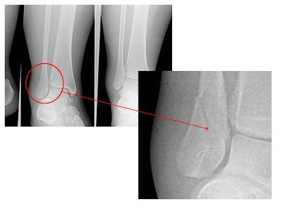 The Butlers: Broken Fibula!!!
