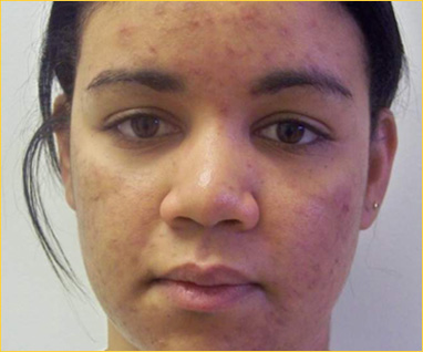 African American and Ethnic Acne Treatment: Before and After Photos