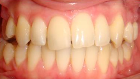 Odontologia Peru: Brackets Internos o Ortodoncia Lingual