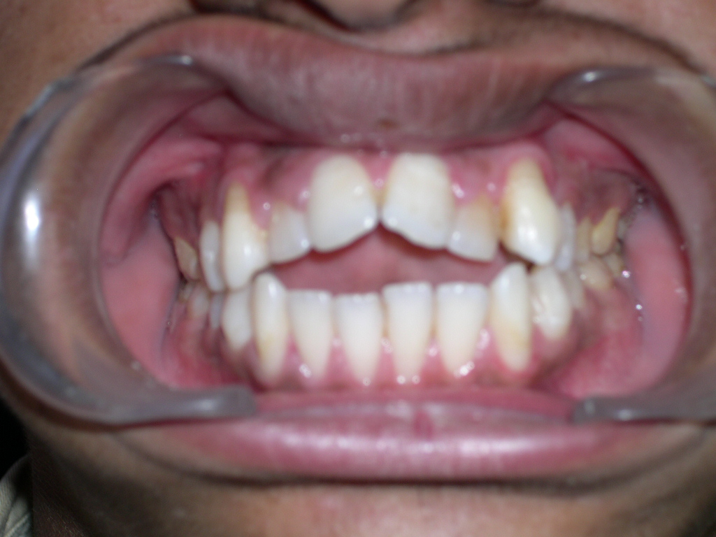 Smile makeovers - Different problems, Different solutions: Dental ...