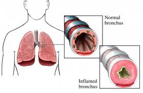 Berilliosis (Beryllium Disease) : Penyakit Paru Akibat Menghirup Debu ...