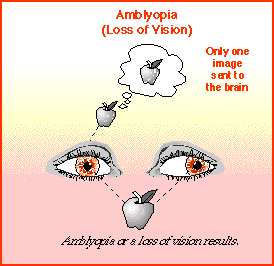 Amblyopia - Terapi Sehat : Info Kesehatan Medis dan Alternatif