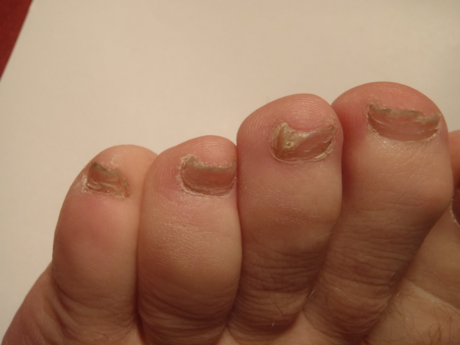 The nail fungus blog: Toenails