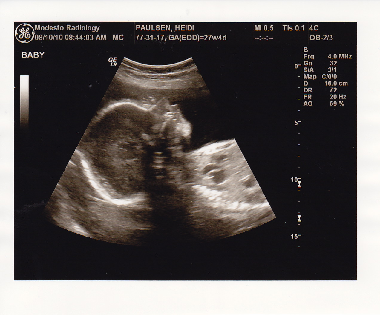 28 Week Fetus Ultrasound