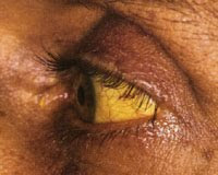 Captains Medic Photos: Jaundice (Ικτερος)