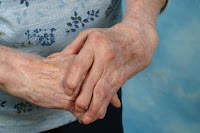 Captains Medic Photos: Rheumatoid Arthritis (Ρευματοειδης Αρθριτιδα)