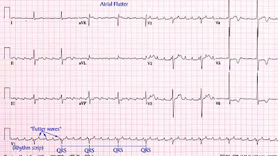 ACLS: Exercise tracing 3