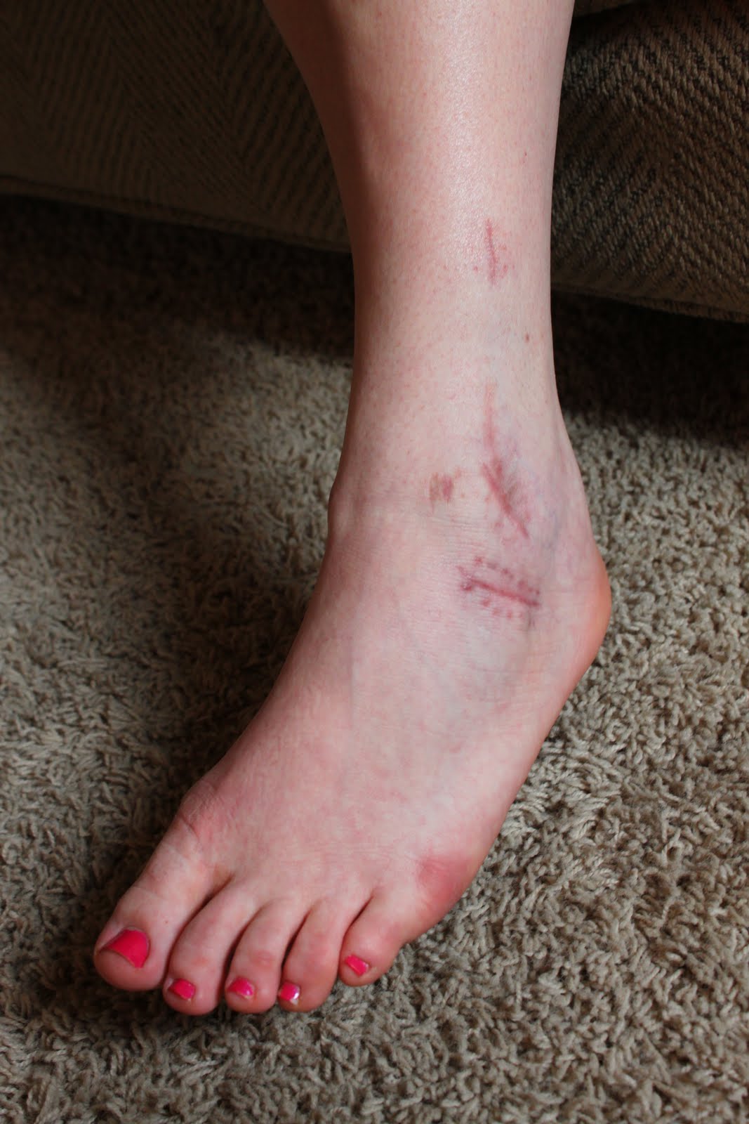 Mary Go Round (How to Fix a Broken Ankle): And the winner is......