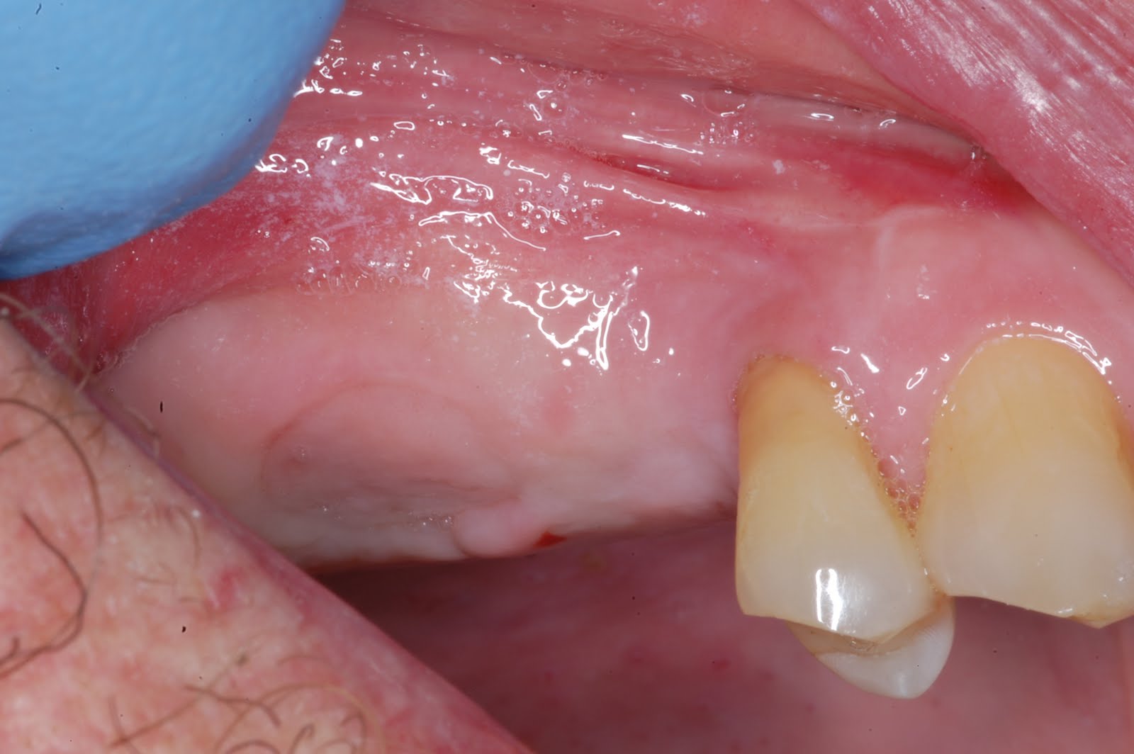 Periodontal - Implant Cases by Dr. Thomas Kang: Sinus Elevation with ...