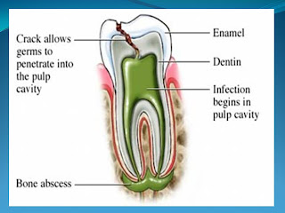 ALTERACIONES BUCALES FES ZARAGOZA: ABSCESO AGUDO, CRONICO Y FENIX