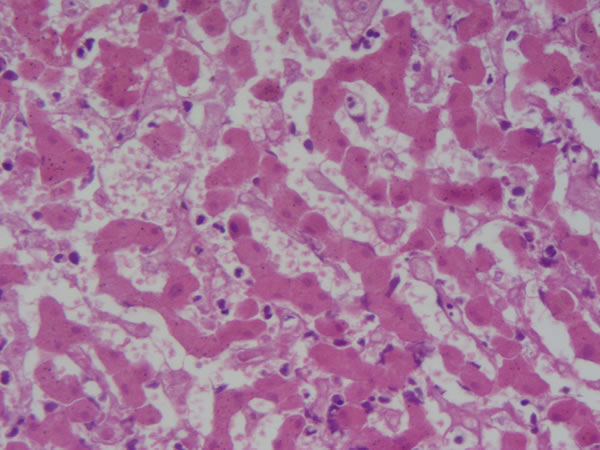 Patologia da Enfermagem: Necrose de Coagulação.