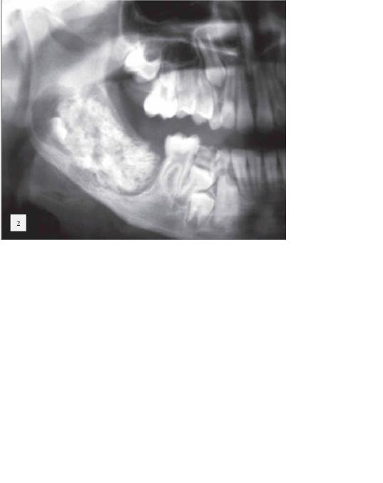 Saint Joseph's Pediatric Dentistry Lit Review: Removal of a Complex ...